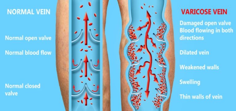 Varicose Veins Information